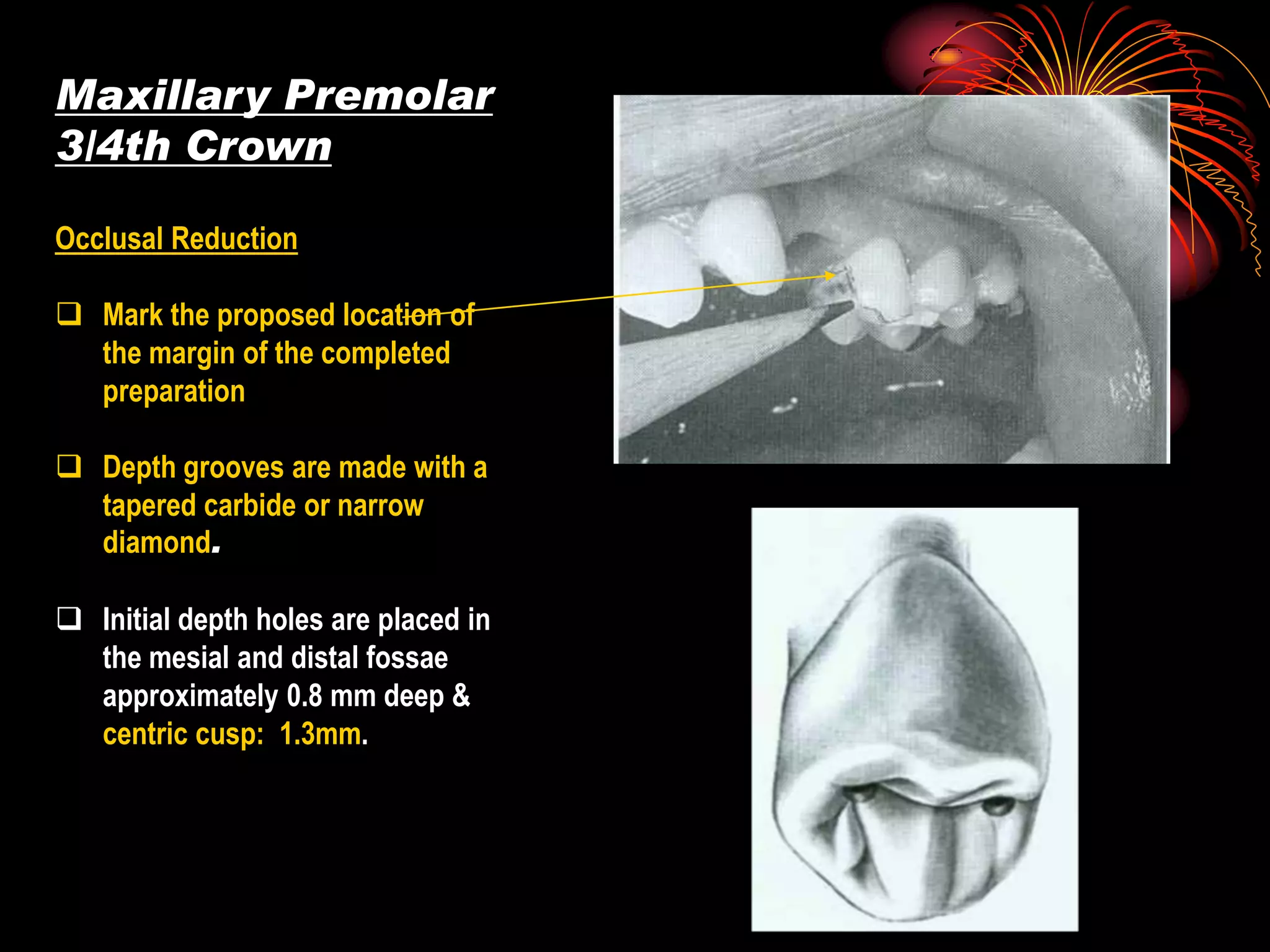 partial coverage restorations | PDF | Dental Health | Diseases and ...