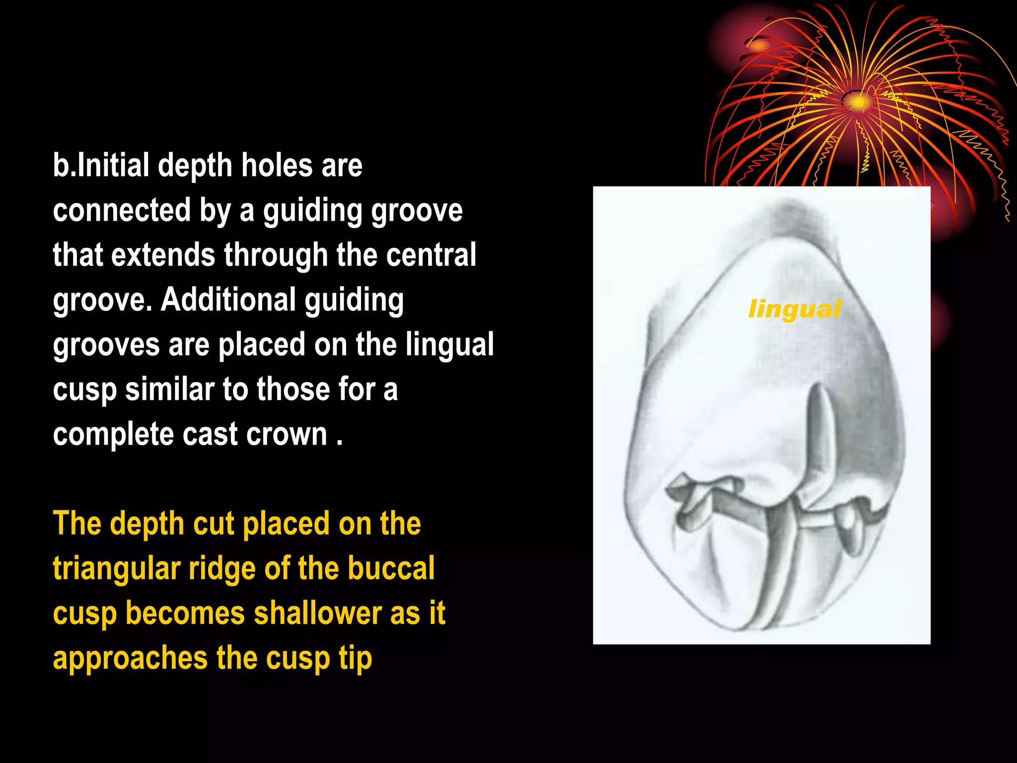 partial coverage restorations | PDF