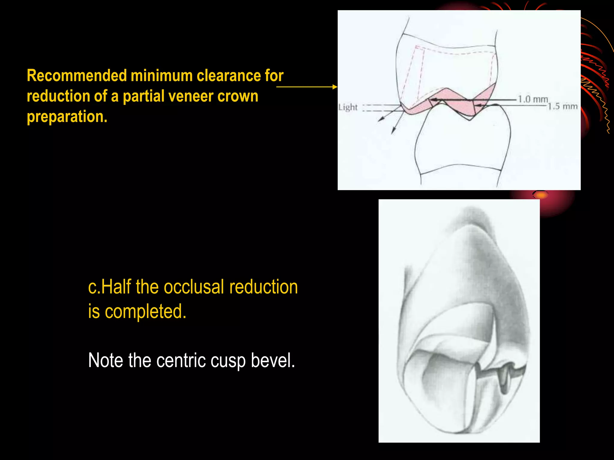 partial coverage restorations | PDF