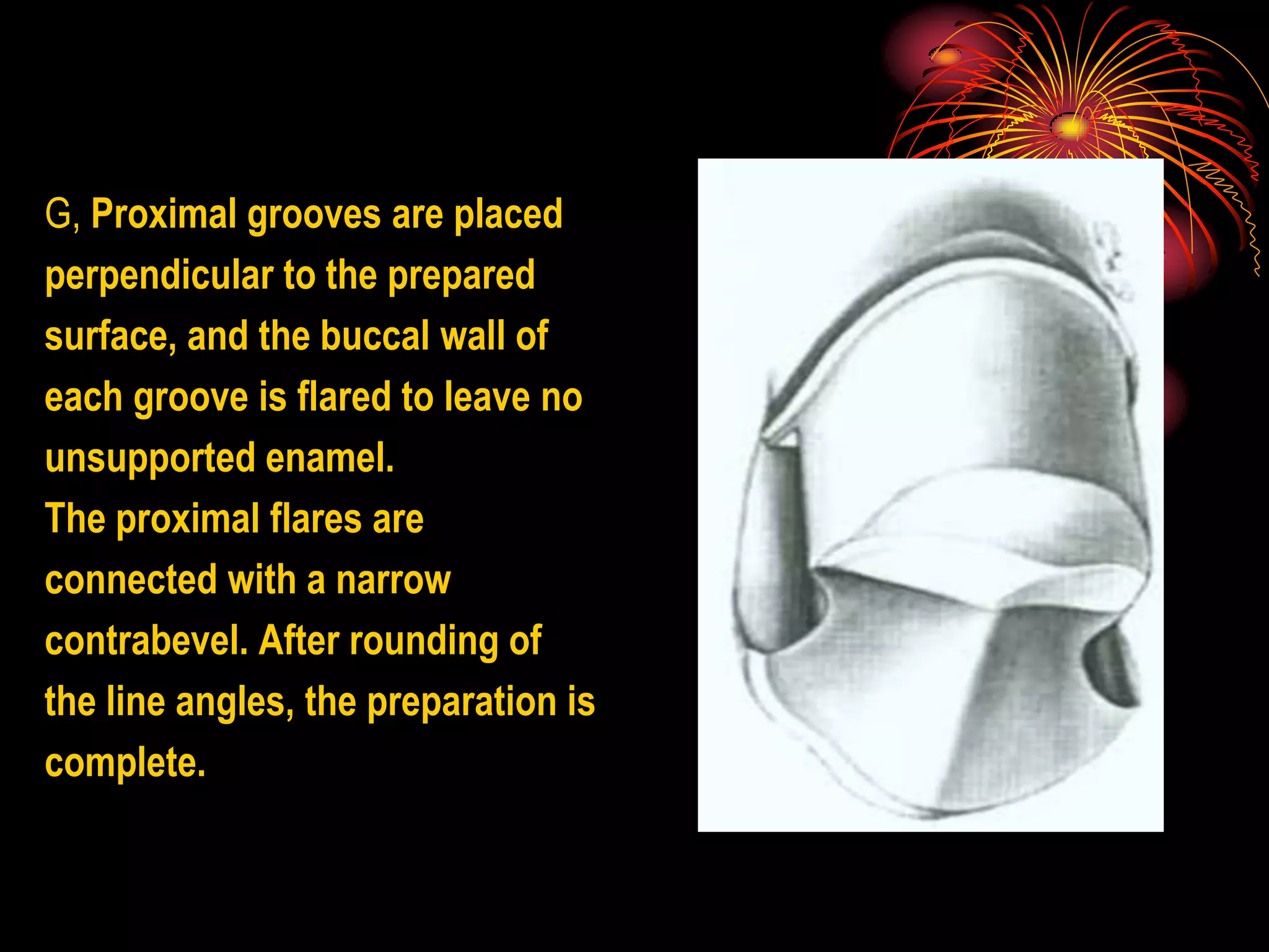 partial coverage restorations | PDF