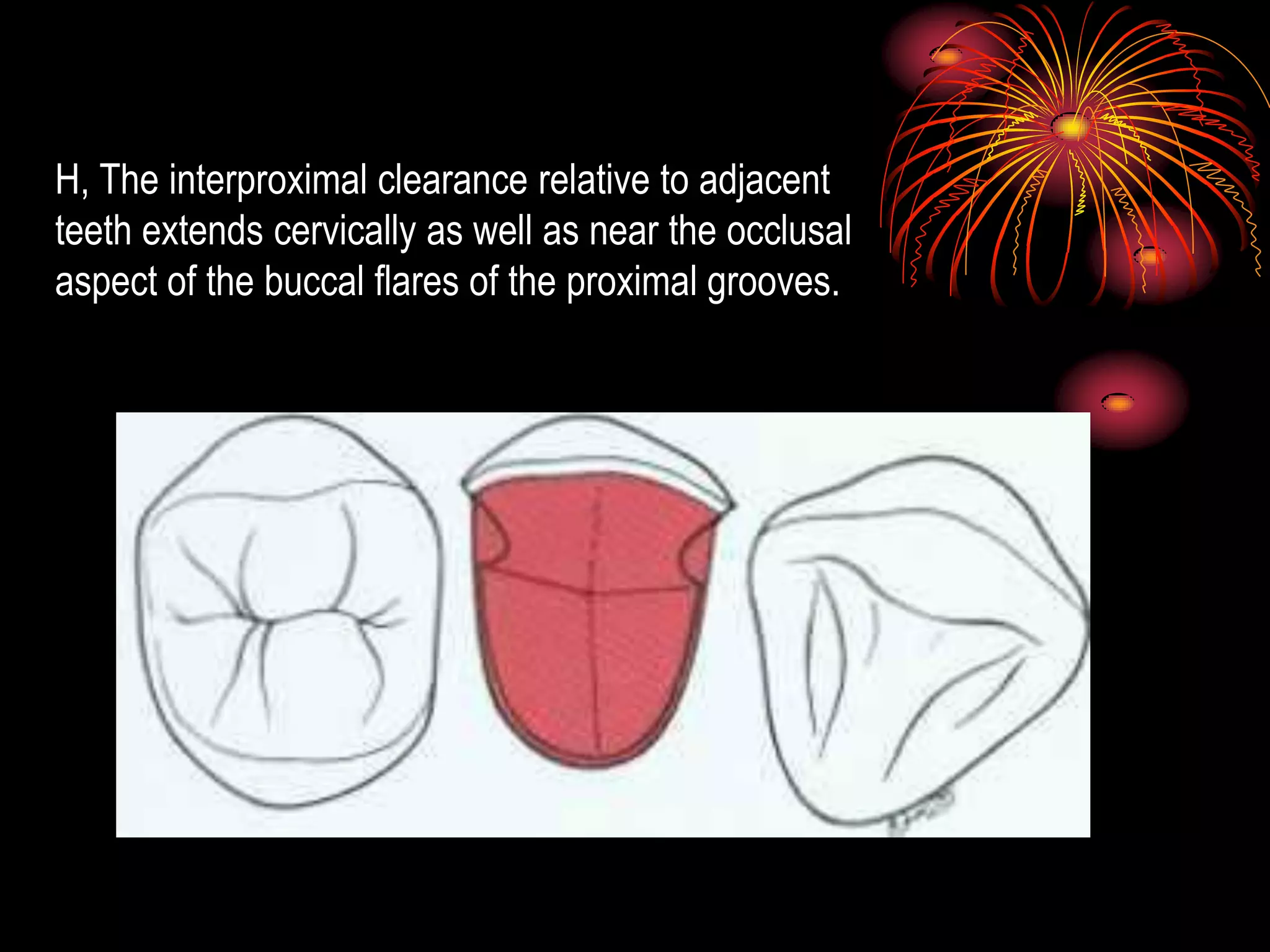 partial coverage restorations | PDF