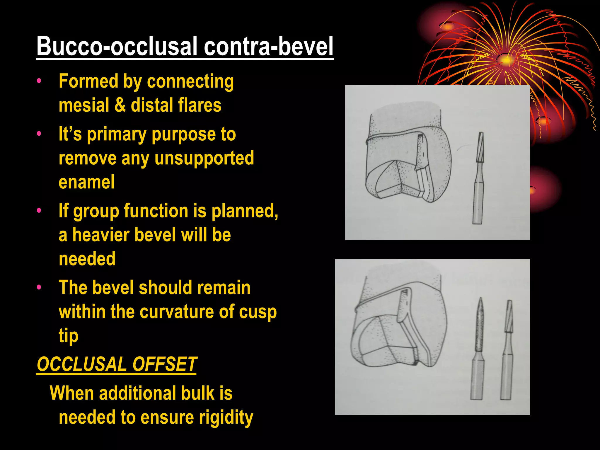 partial coverage restorations | PDF
