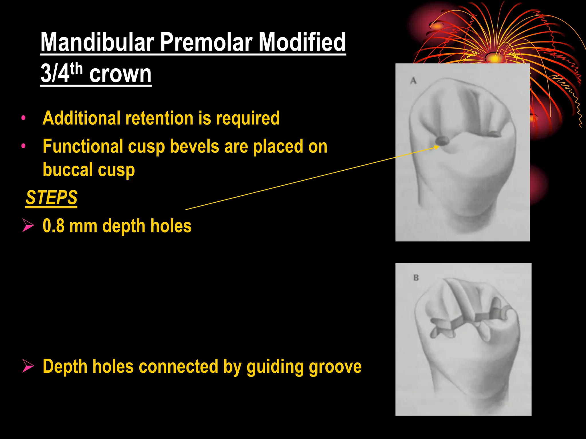 partial coverage restorations | PDF