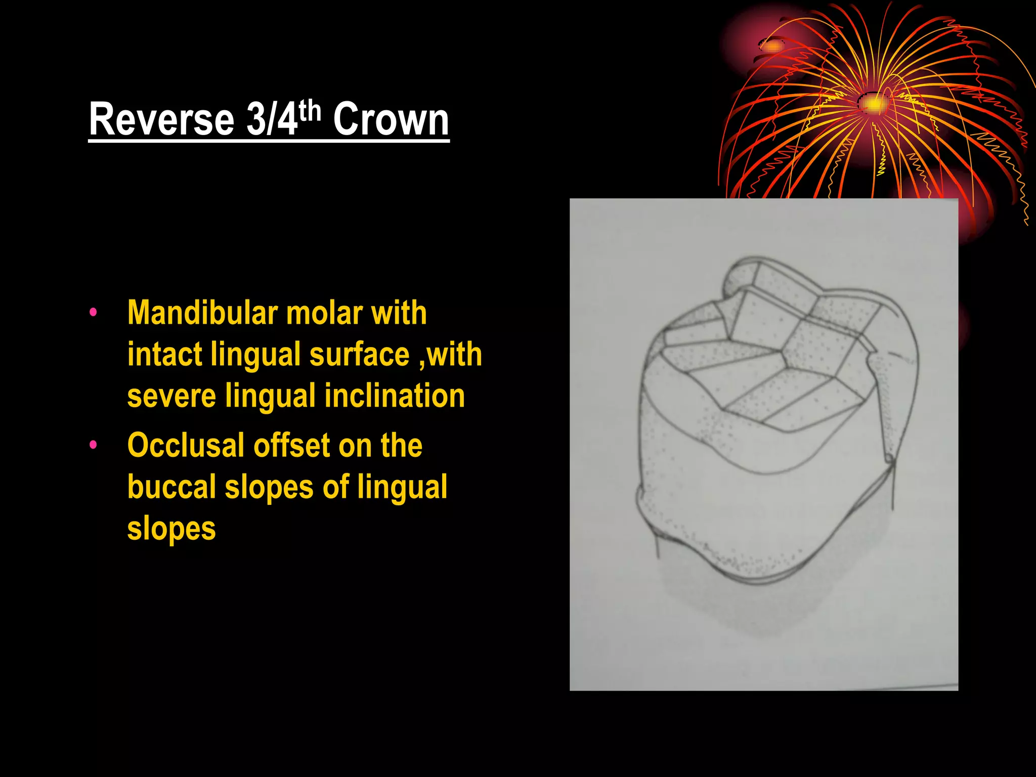partial coverage restorations | PDF
