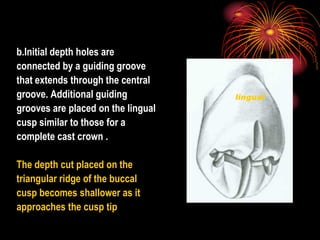 partial coverage restorations | PDF