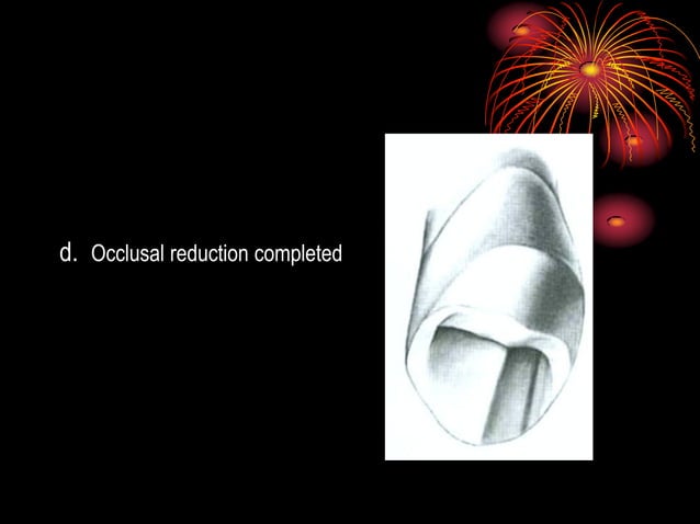 partial coverage restorations | PDF | Dental Health | Diseases and ...