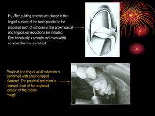 partial coverage restorations | PDF