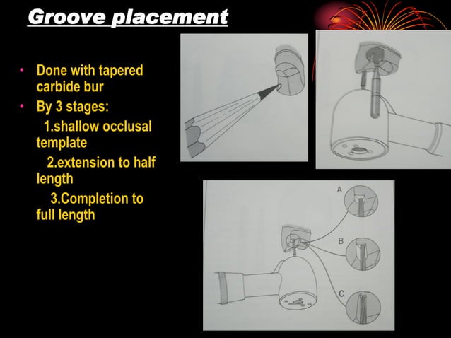 partial coverage restorations | PDF | Dental Health | Diseases and ...