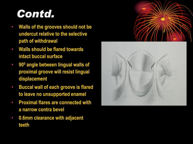 partial coverage restorations