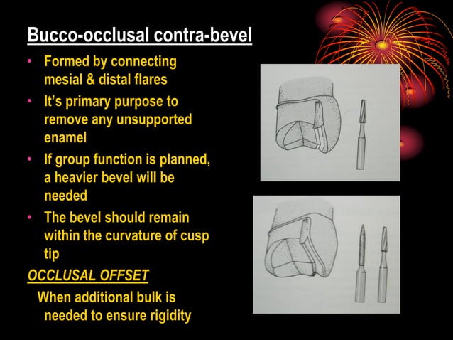 partial coverage restorations