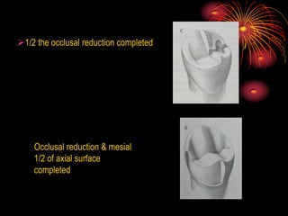 partial coverage restorations | PDF