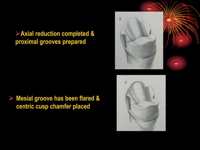 partial coverage restorations | PDF | Dental Health | Diseases and ...