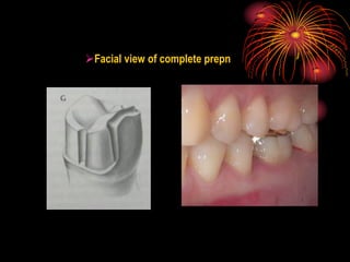 partial coverage restorations | PDF