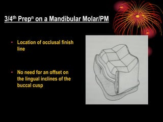 partial coverage restorations | PDF