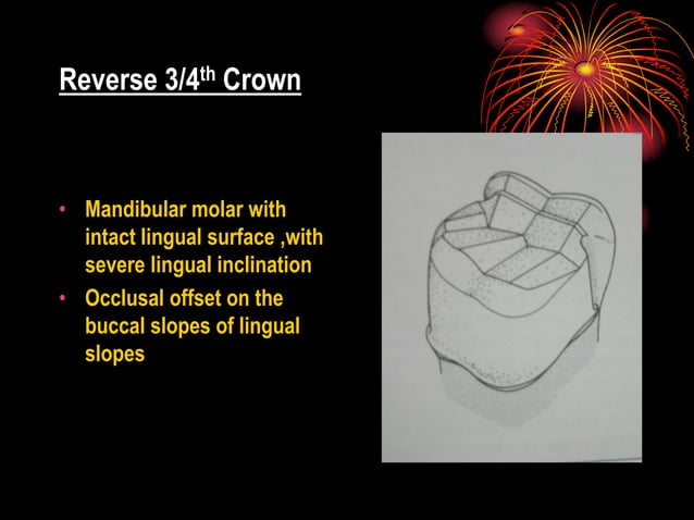 partial coverage restorations | PDF | Dental Health | Diseases and ...