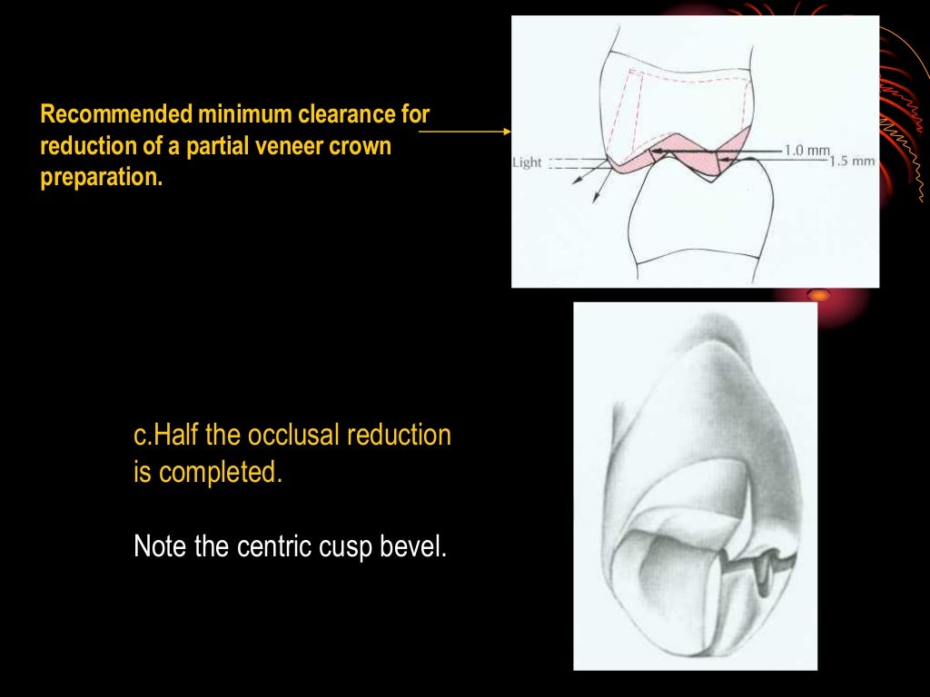 partial coverage restorations