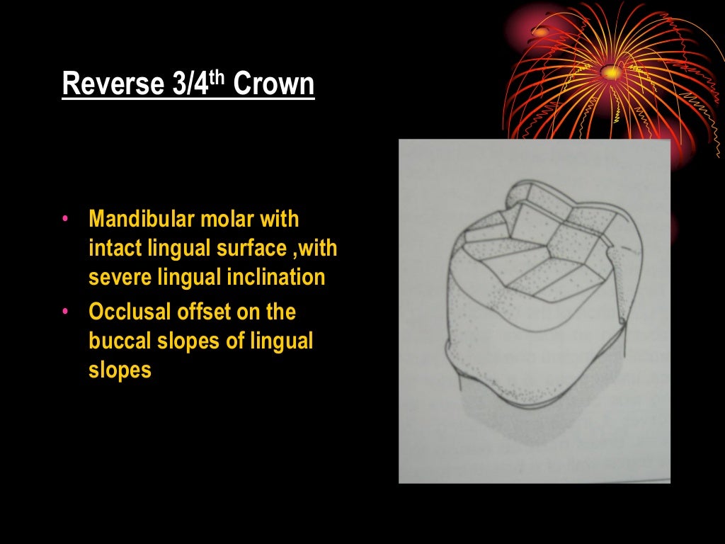 partial coverage restorations