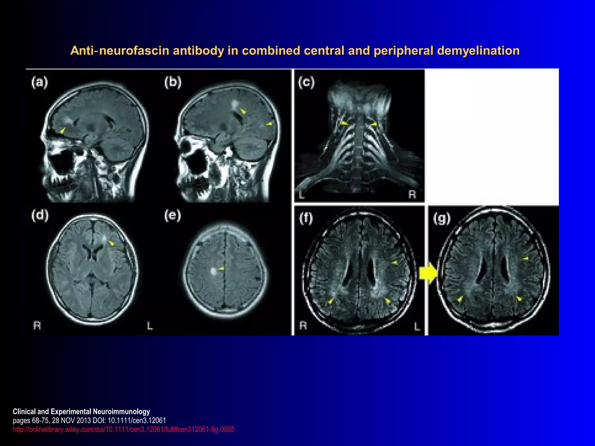 Combined Central and Peripheral Demyelination - Dr E. Tack | PPT