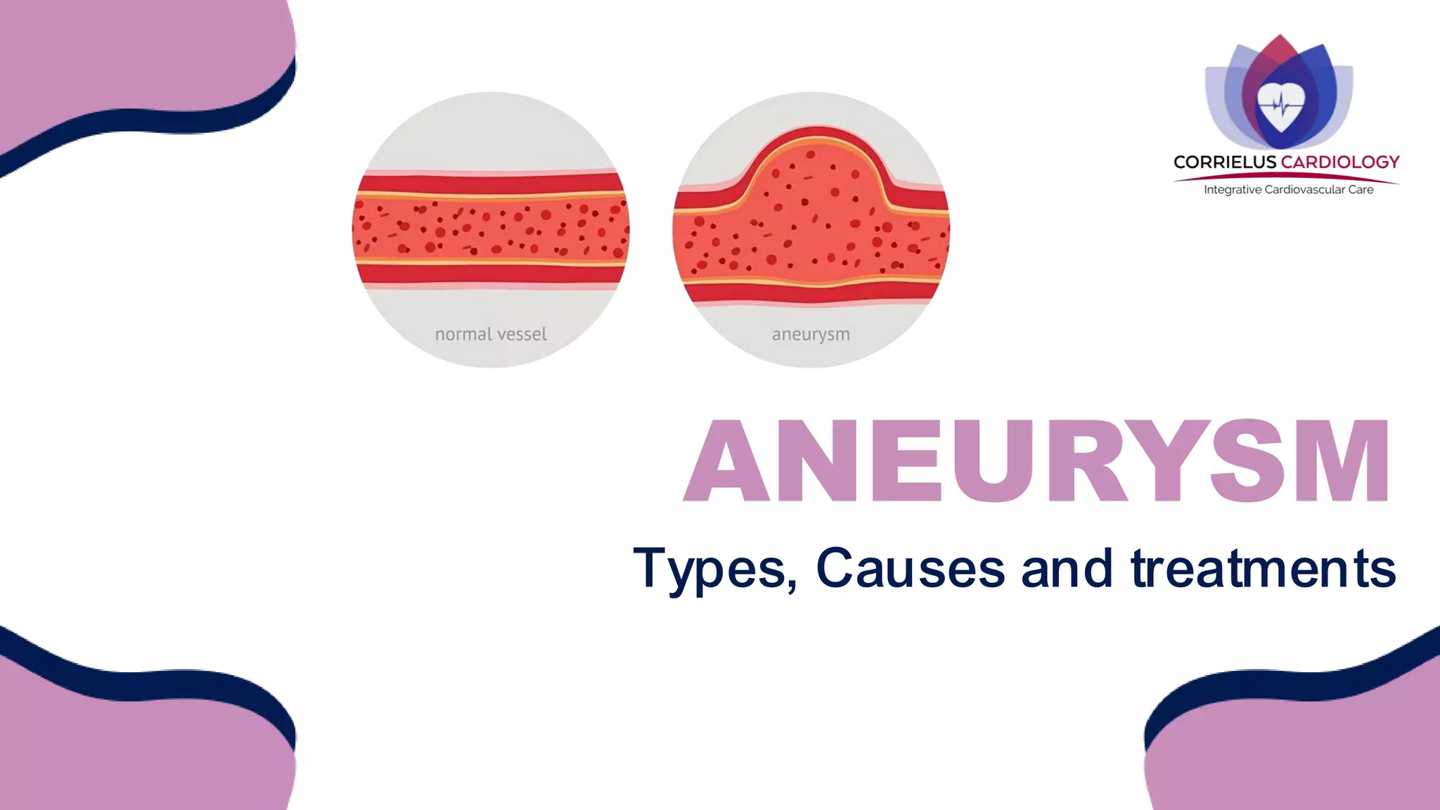 Aneurysm: Types, causes & treatment | PPTX