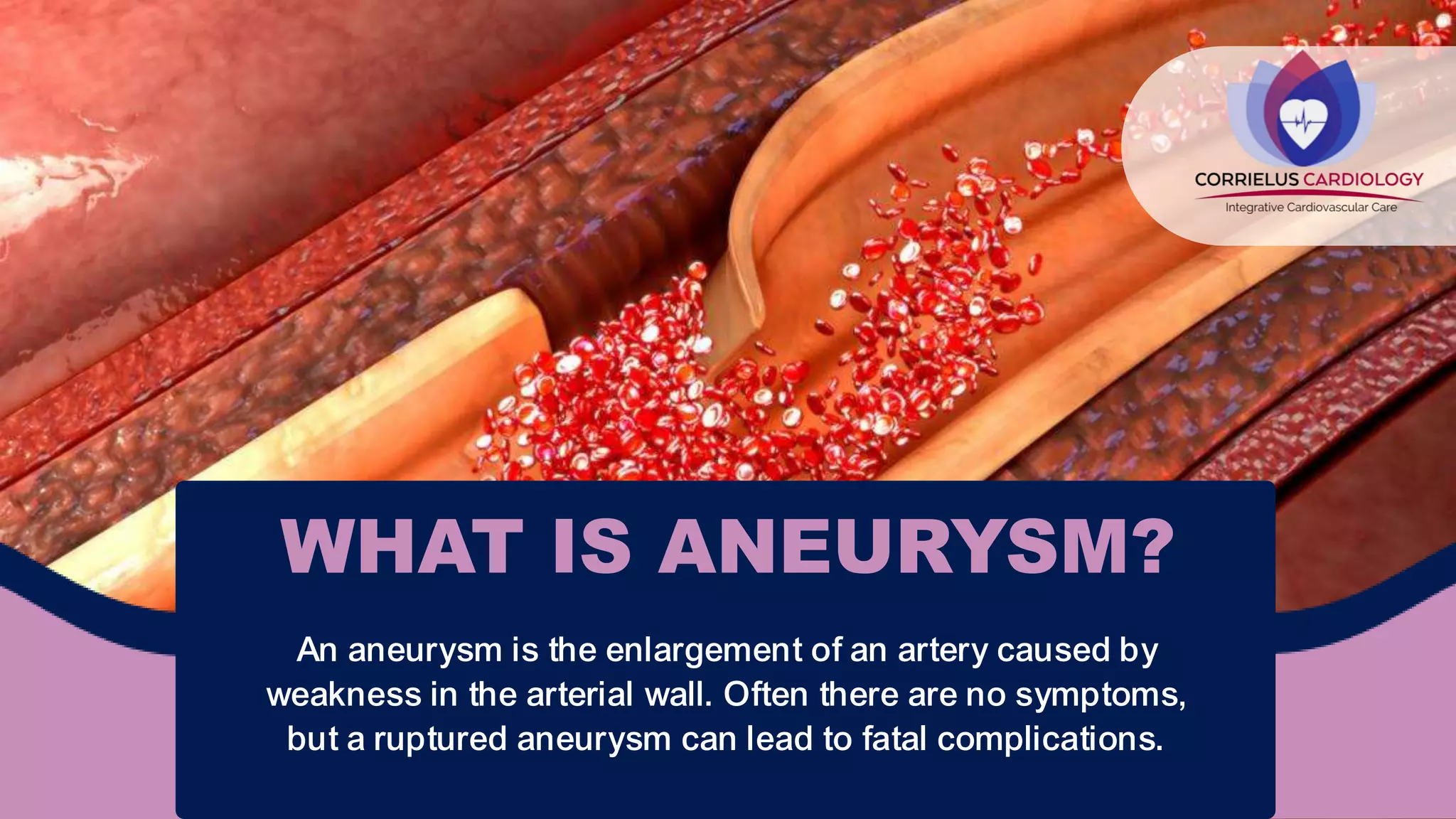 Aneurysm: Types, causes & treatment | PPTX