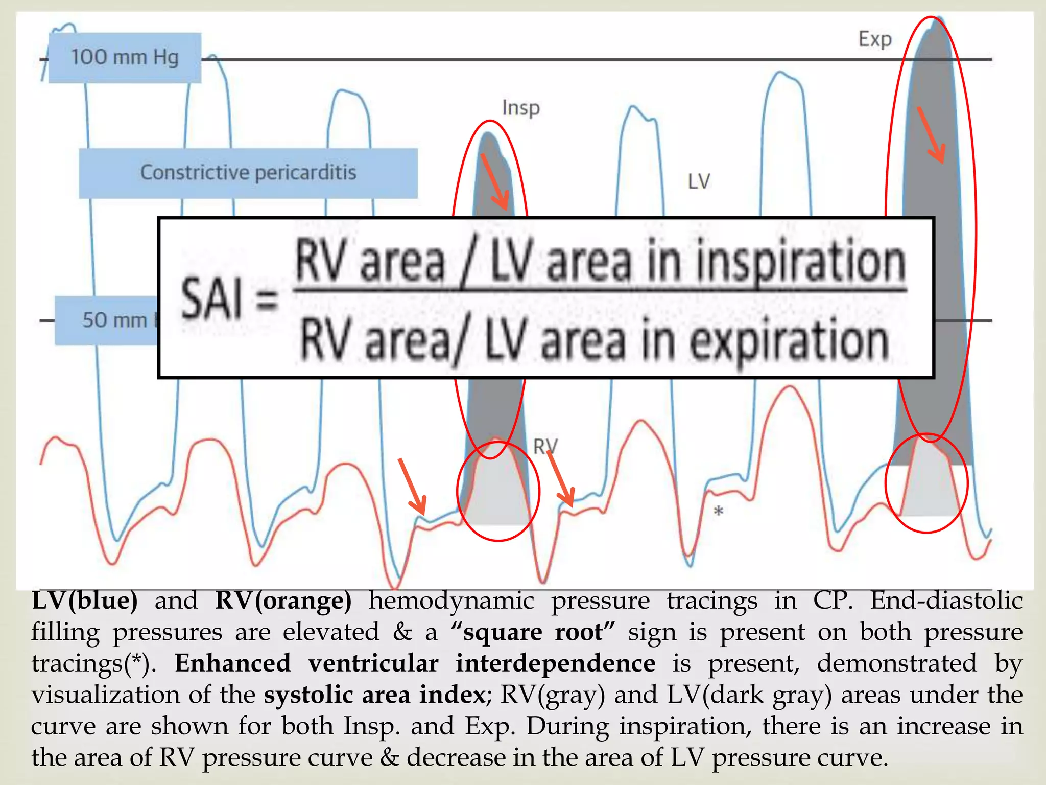 Hemodyanmic features of Constrictive pericarditis and Restrictive ...