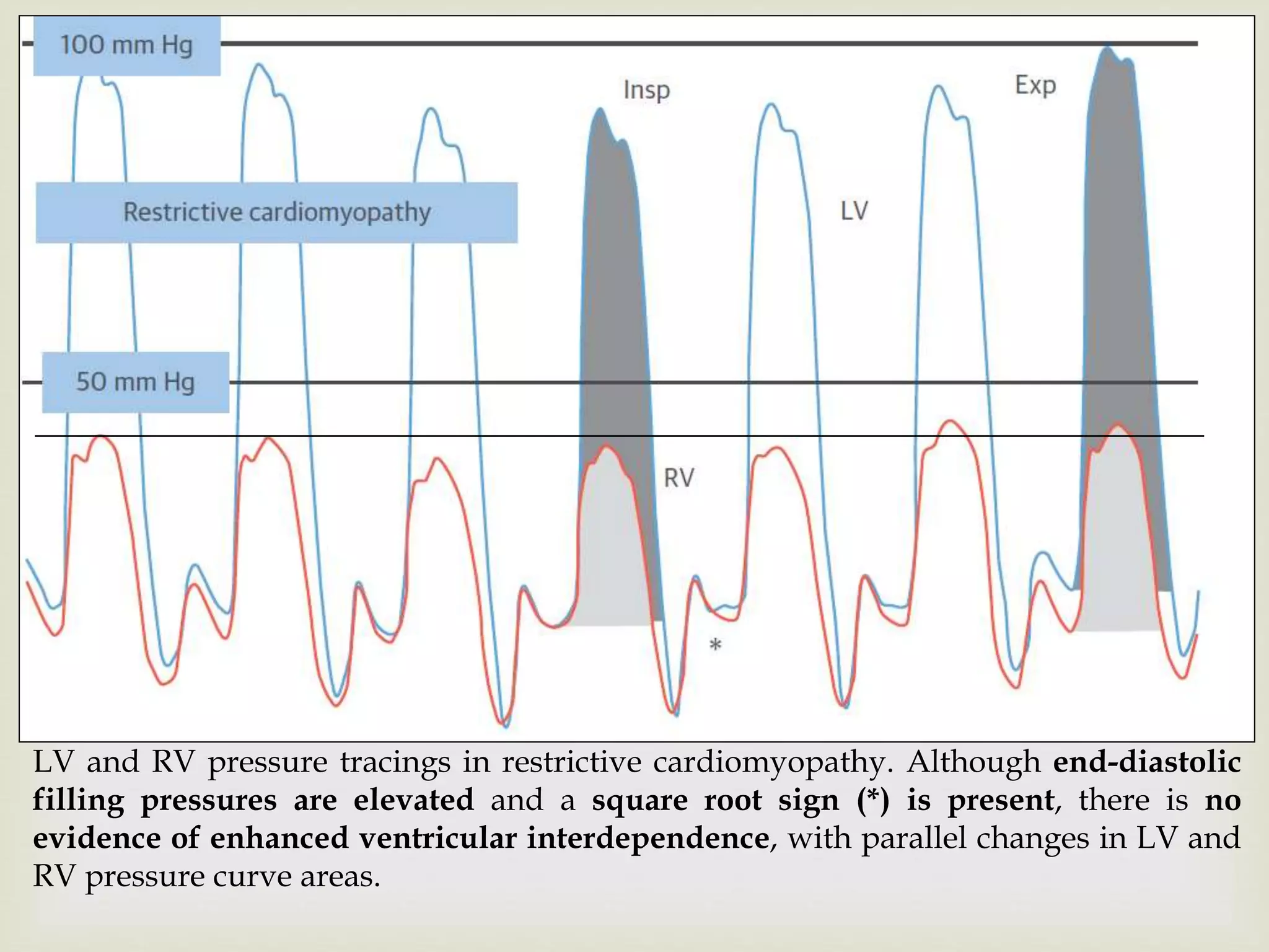 Hemodyanmic features of Constrictive pericarditis and Restrictive ...