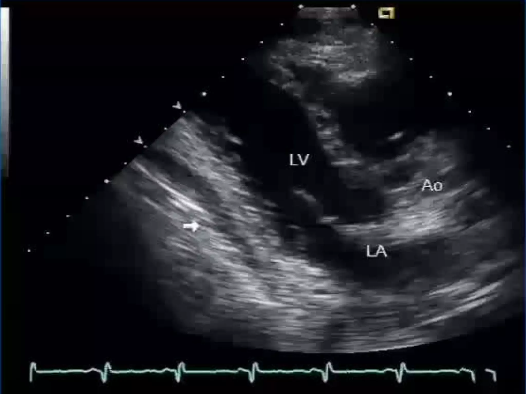 Hemodyanmic features of Constrictive pericarditis and Restrictive ...