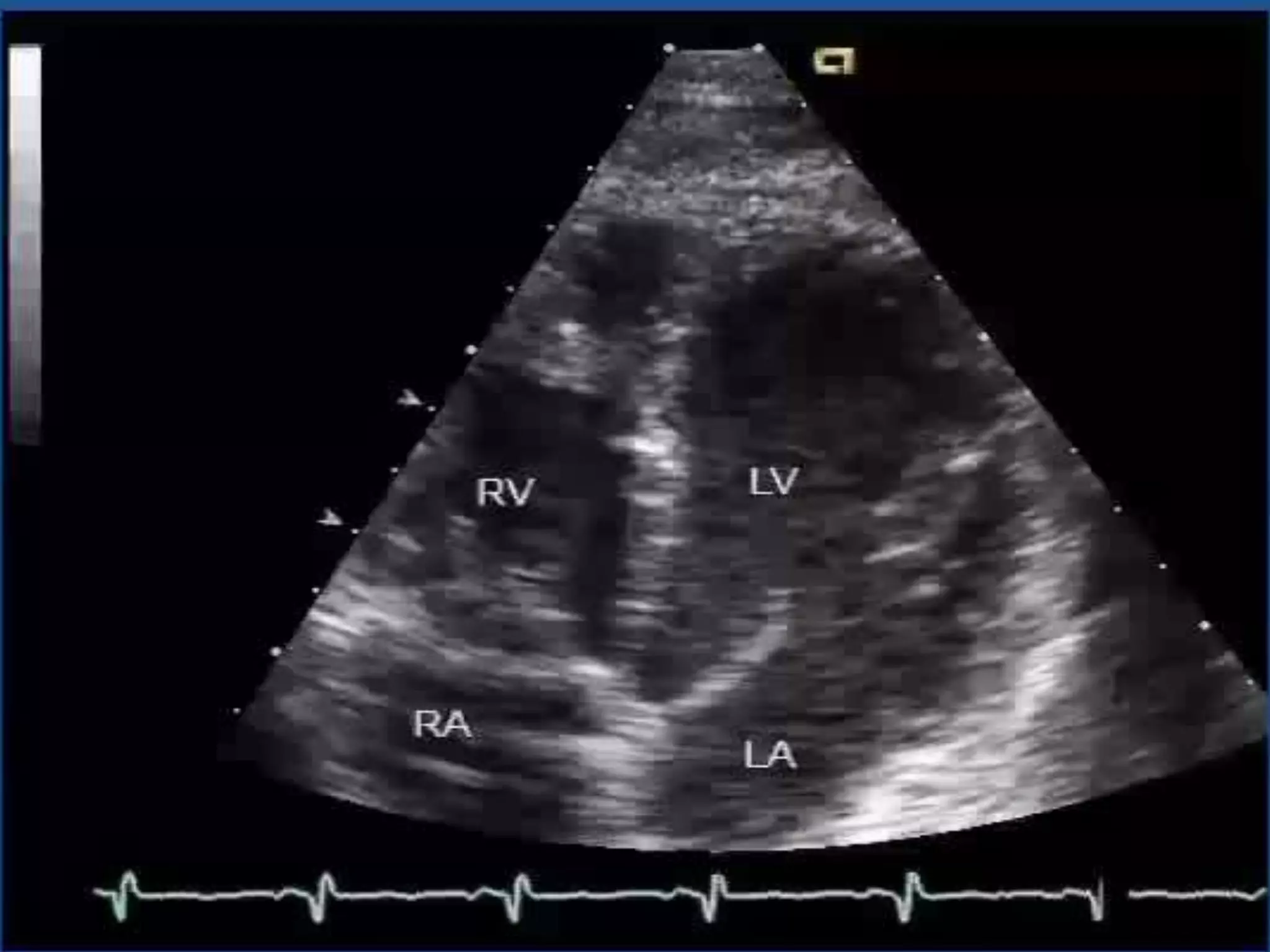 Hemodyanmic features of Constrictive pericarditis and Restrictive ...