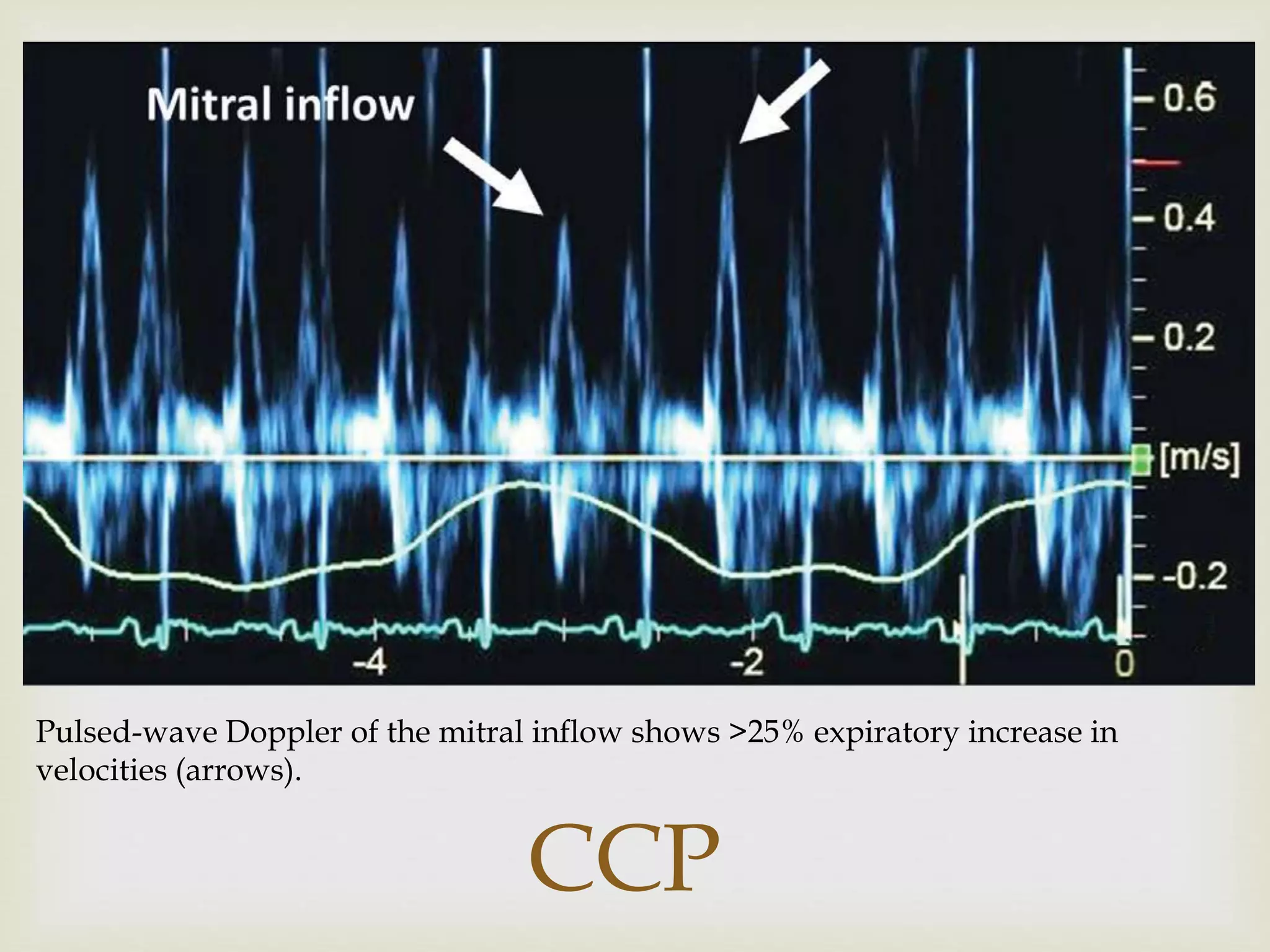 Hemodyanmic features of Constrictive pericarditis and Restrictive ...