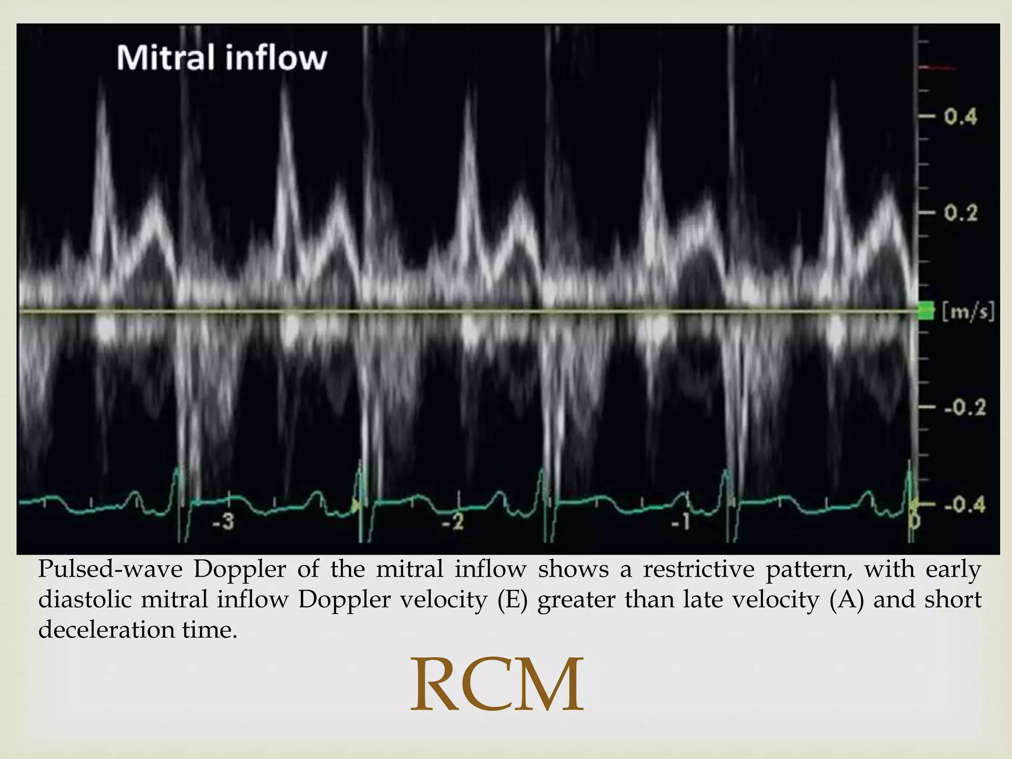 Hemodyanmic features of Constrictive pericarditis and Restrictive ...