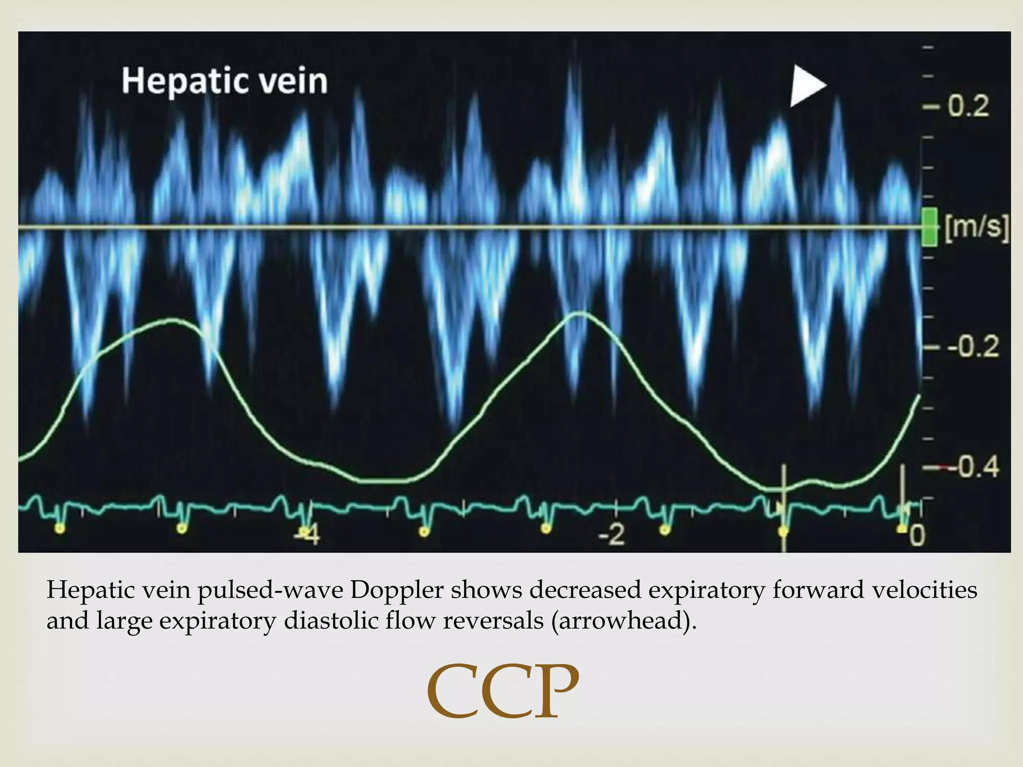 Hemodyanmic features of Constrictive pericarditis and Restrictive ...