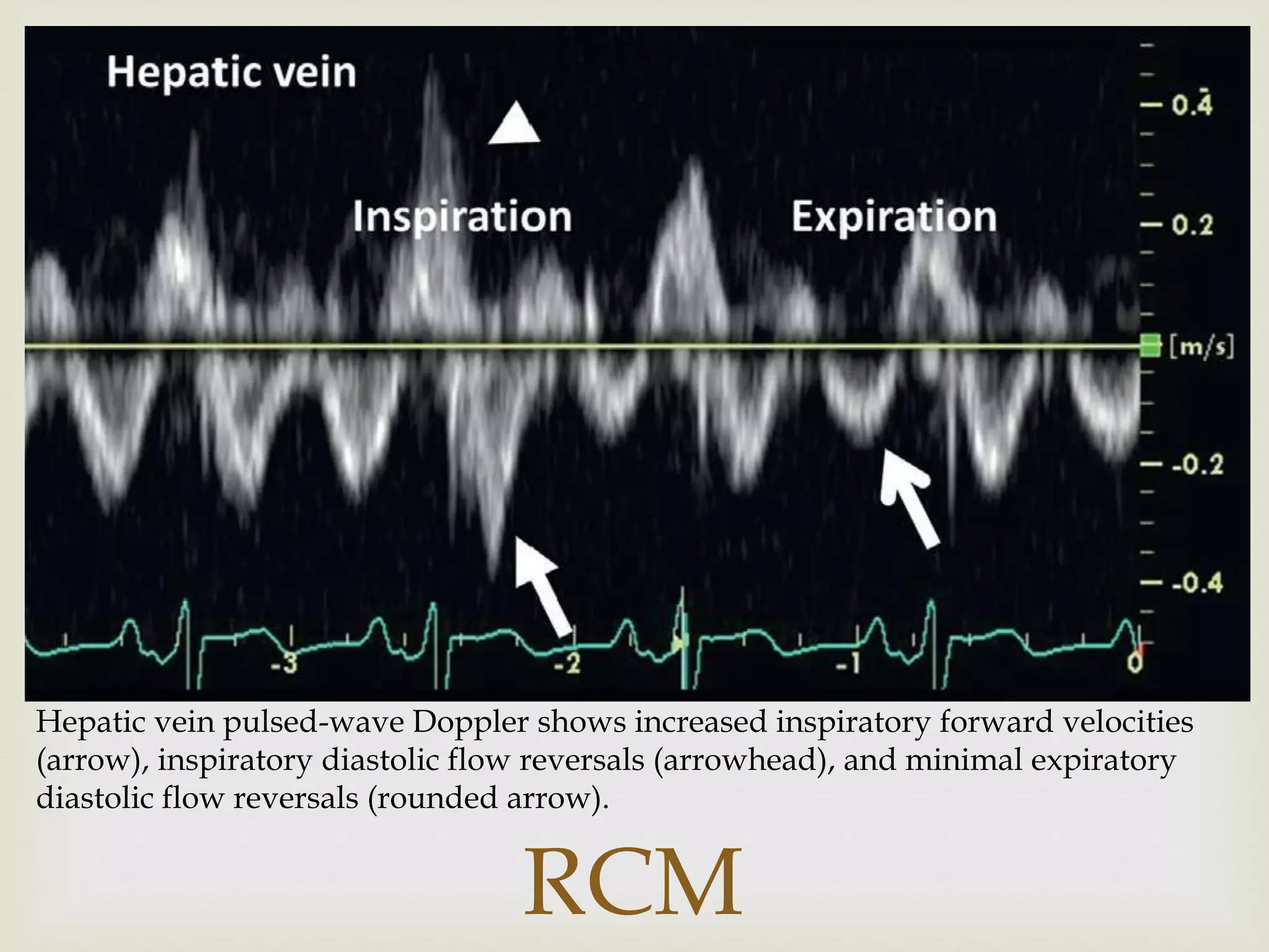 Hemodyanmic features of Constrictive pericarditis and Restrictive ...