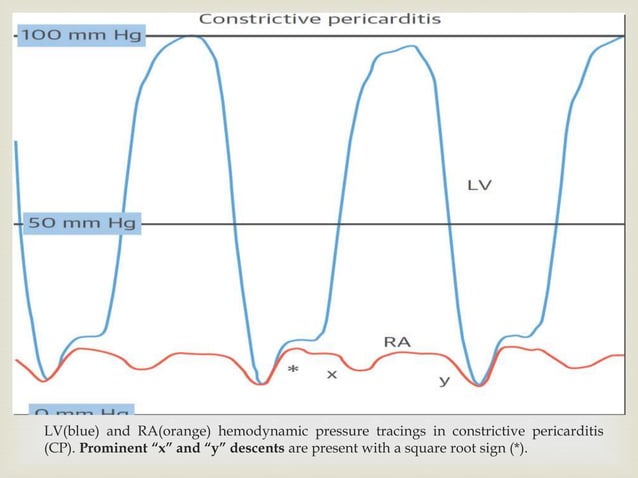 Hemodyanmic features of Constrictive pericarditis and Restrictive ...