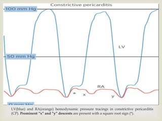 Constrictive Pericarditis Square Root Sign