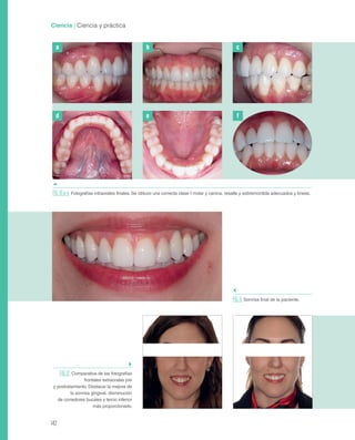 Caso Clínico Una alternativa a la corrección de sonrisa gingival y ...