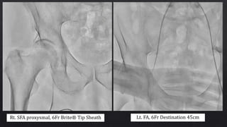 CROSSVAC - A new and aggressive flossing strategy | PPTX