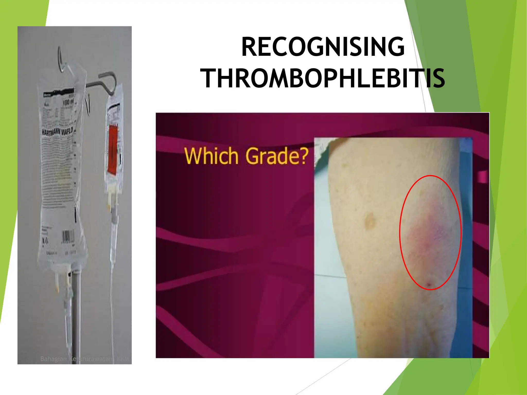 nursing indicator thrombophlebitis.pptx