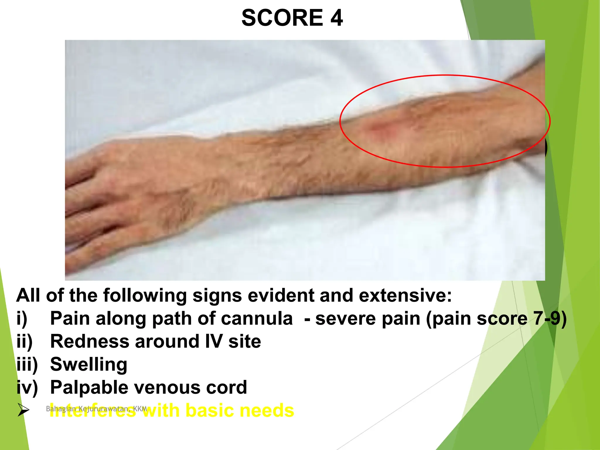 nursing indicator thrombophlebitis.pptx
