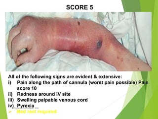 nursing indicator thrombophlebitis.pptx