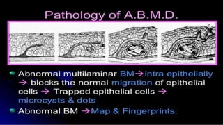 Epithelial Basement Membrane Dystrophy Pathology