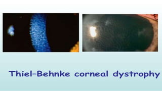 Thiel Behnke Corneal Dystrophy