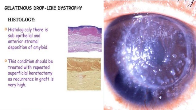 Corneal Dystrophies