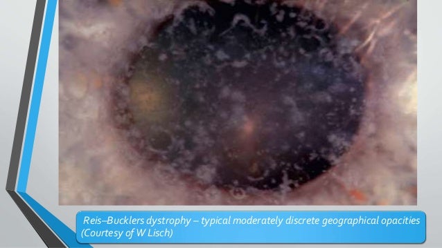 Corneal Dystrophies