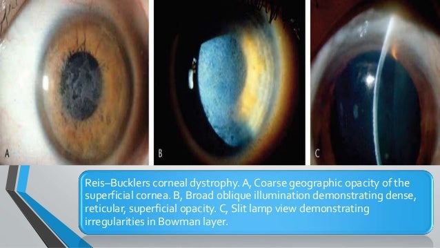Corneal Dystrophies