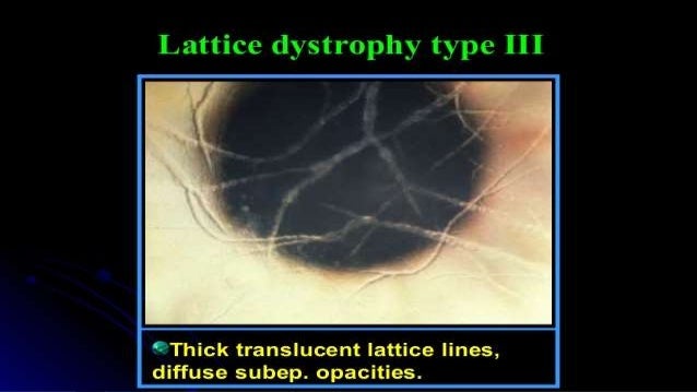 Corneal Dystrophies