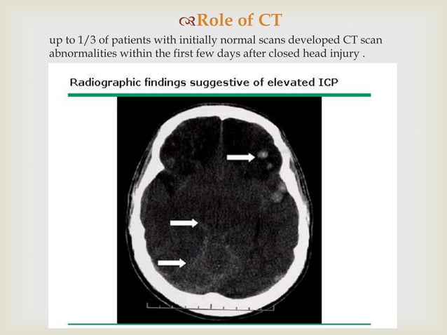 Increased intracranial pressure | PPTX | Death, Injury, or Military ...