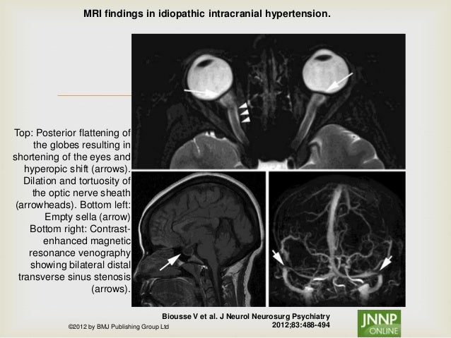 Increased intracranial pressure