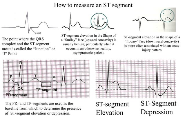 Algorithm for Rhythm Interpretation1 | PPT