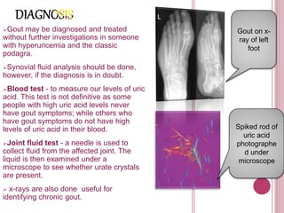 GOUT | PPTX
