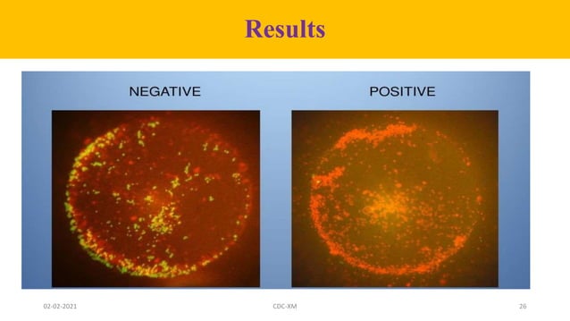 CDC-XM / Complement dependent cytotoxicity -crossmatch | PPTX | Blood ...